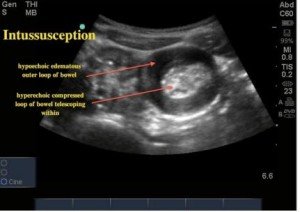 Intussusception - Symptoms, What is, Treatment, Pictures